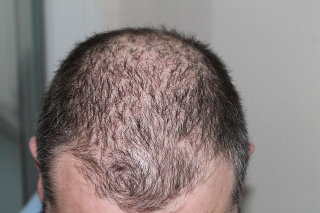 Hair Man Loss - Free photo on Pixabay