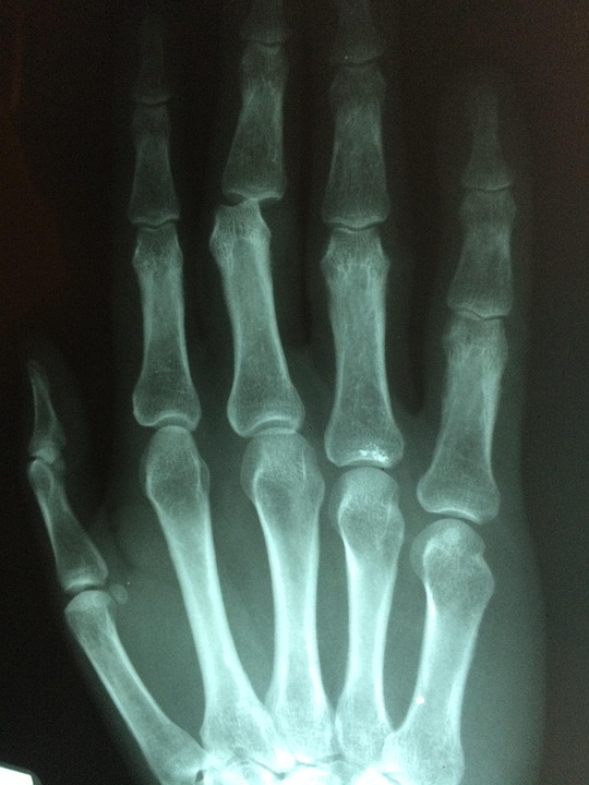 Mano Fractura Roto - Foto gratis en Pixabay - Pixabay