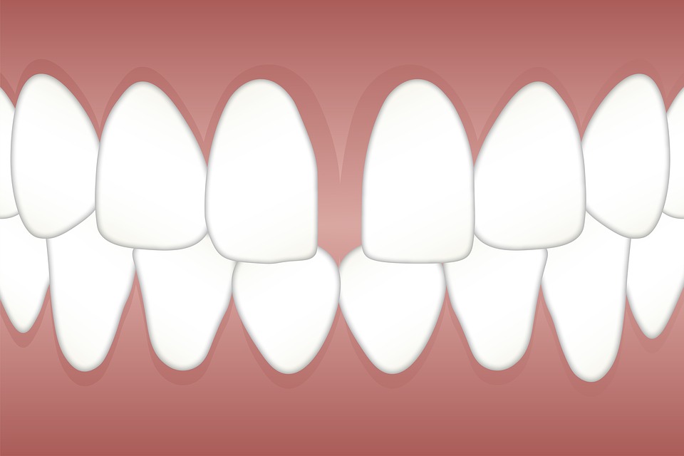 Dental Diastema Space - Free image on Pixabay