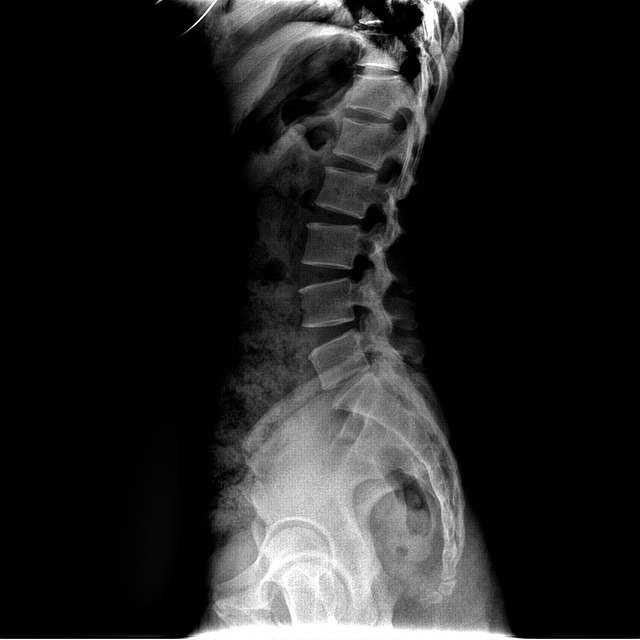 X-Ray Skeletal Chest - Free photo on Pixabay - Pixabay