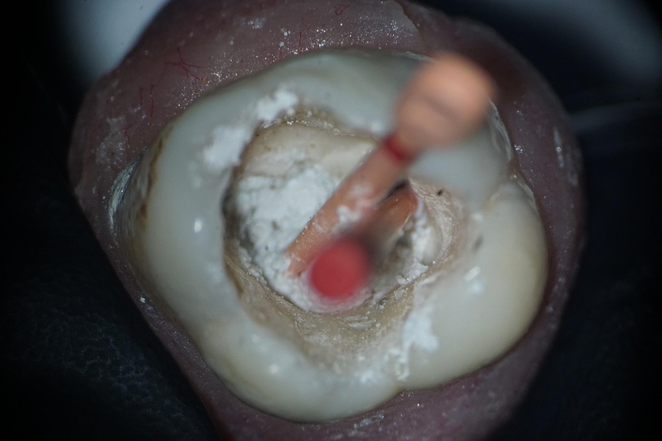 Endodoncia Obturación - Free photo on Pixabay - Pixabay