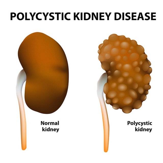 Polycystic Kidney Disease - Free photo on Pixabay - Pixabay