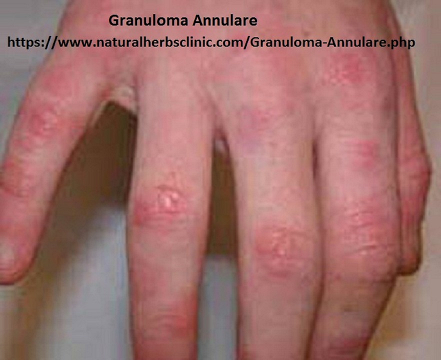 Granuloma Annulare - ภาพฟรีบน Pixabay - Pixabay