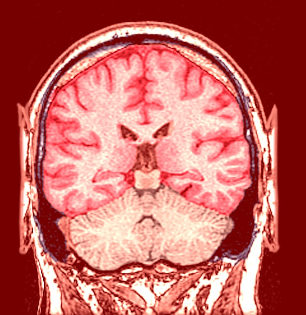 Brain Mri Scan Neuro Free Image On Pixabay