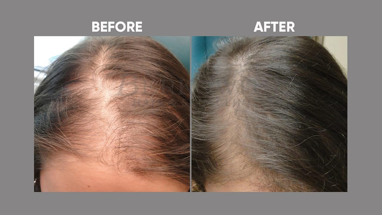 Female Hair Transplant In Delhi - Free photo on Pixabay - Pixabay