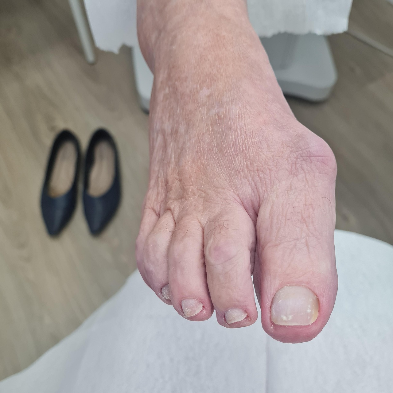Pedicure Podology Ingrown Nail - Free photo on Pixabay - Pixabay